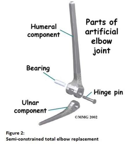 Elbow Surgery | NRAS and information on Elbow Surgery