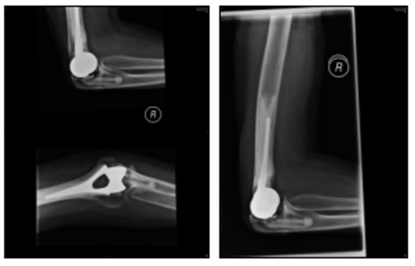 Elbow Surgery | NRAS and information on Elbow Surgery