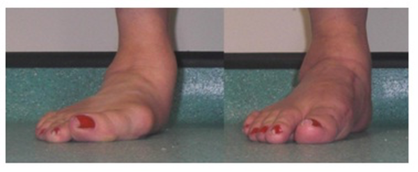 Foot Surgery for rheumatoid arthritis patients | NRAS