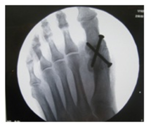Foot Surgery for rheumatoid arthritis patients | NRAS