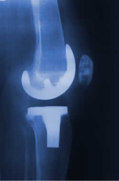 Knee Replacement - A Patient's Perspective | NRAS