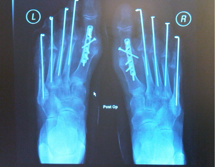 Rheumatoid Arthritis And Surgery | NRAS