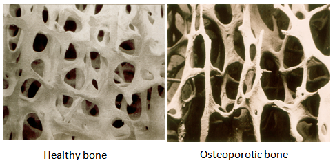 Osteoporosis in RA | NRAS