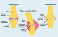 What Is Rheumatoid Arthritis? Rheumatoid Arthritis Explained | NRAS